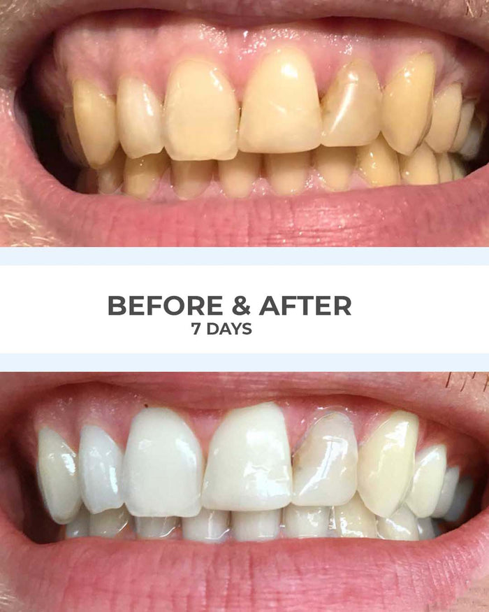 Teeth Whitening Kit – Advanced At-Home Results | SmilePro