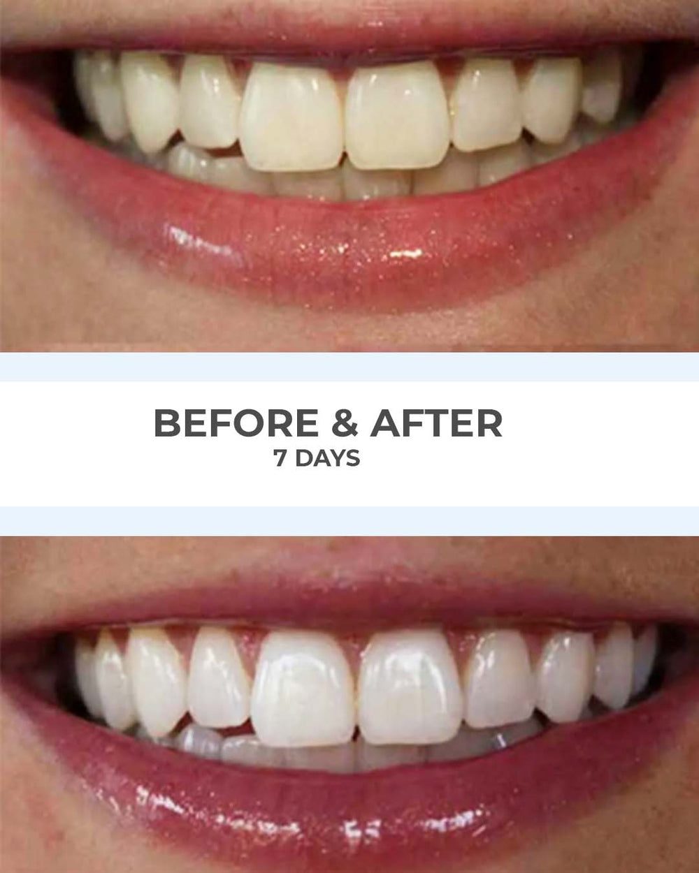 Teeth Whitening Kit – Advanced At-Home Results | SmilePro