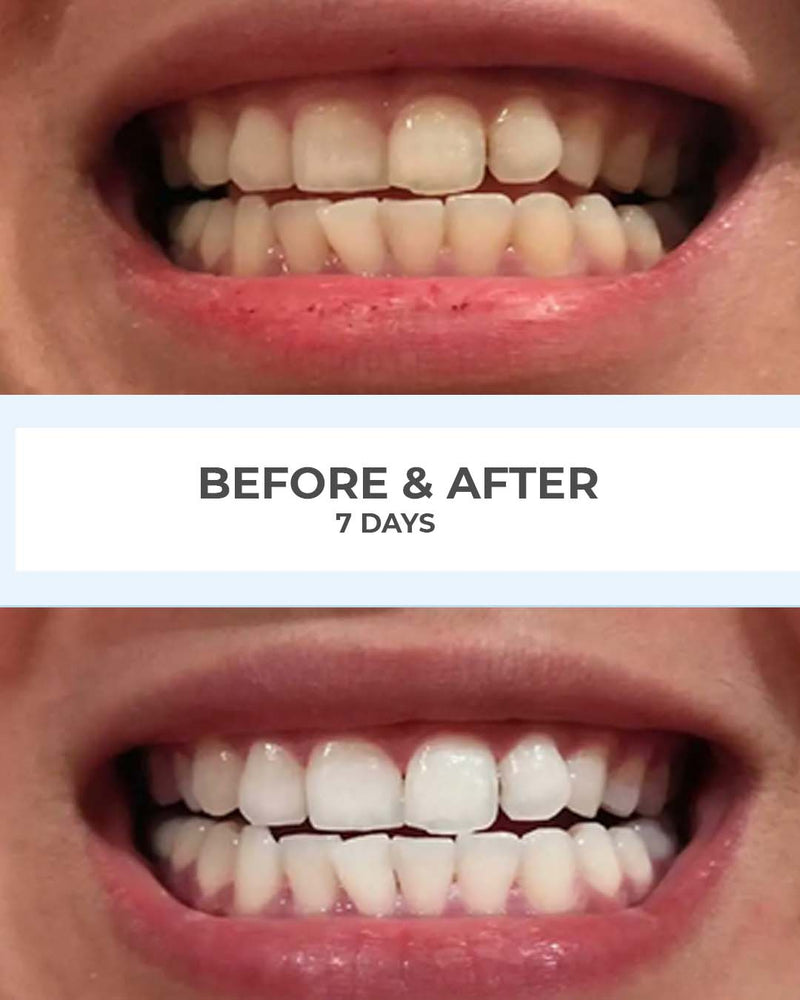 Teeth Whitening Kit – Advanced At-Home Results | SmilePro